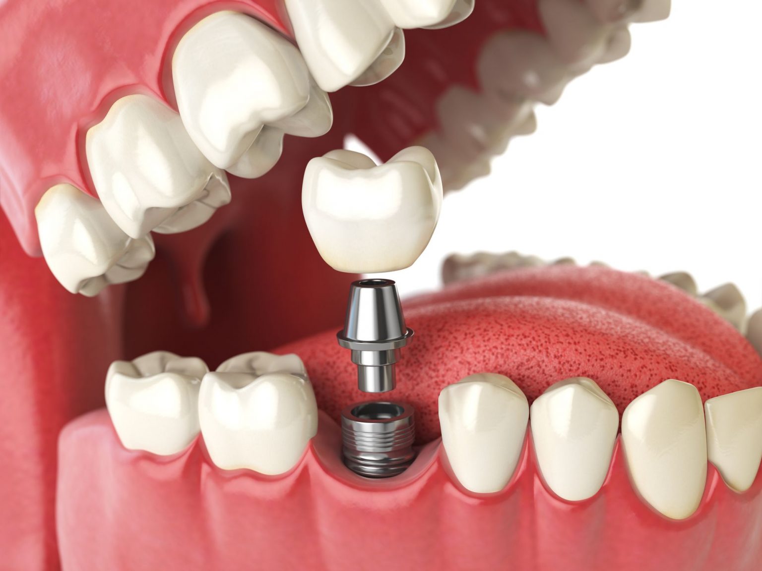 Dental Implants – Green Apple Dental Studio